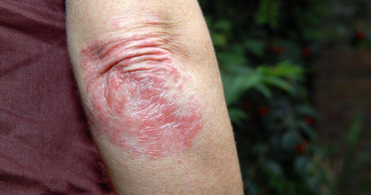 Arm Rash - Symptome, Ursachen, Behandlungen - Dr.med.Julia.com