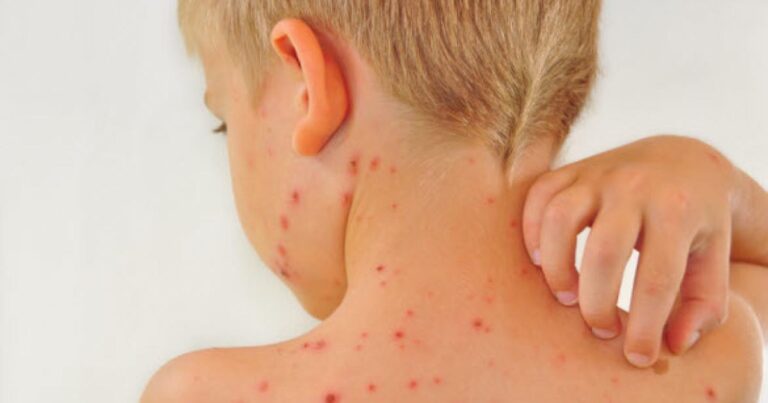 Windpocken - Symptome, Ursachen, Behandlungen - Dr.med.Julia.com