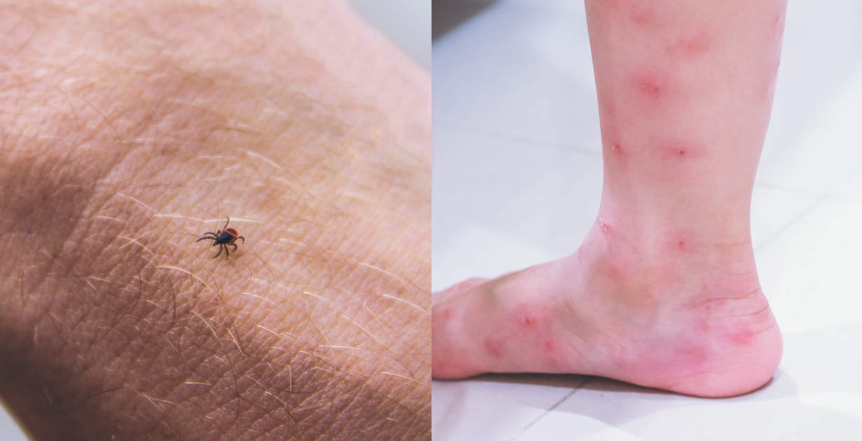 Chigger Bites: Symptome, Ursachen + natürliche Behandlung - Dr.med ...