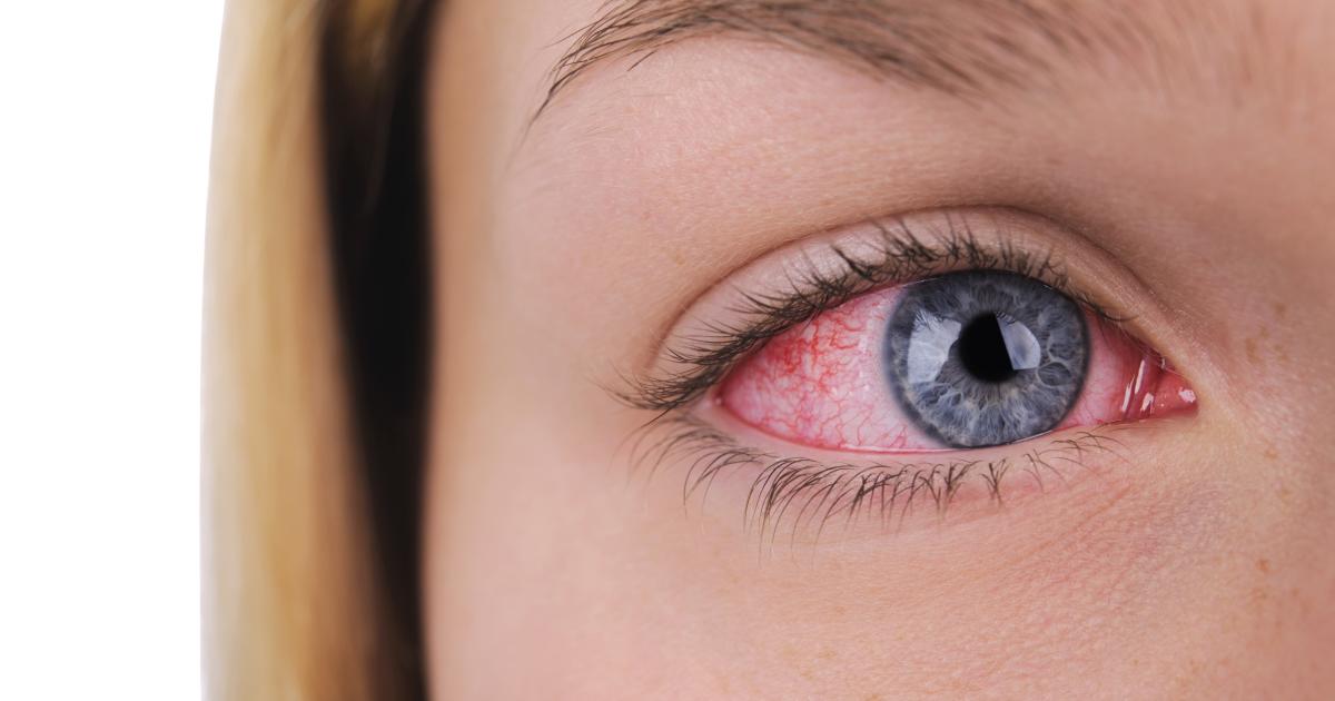Augenherpes - Symptome, Ursachen, Behandlungen - Dr.med.Julia.com