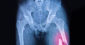 Gebrochener Oberschenkelknochen - Symptome, Ursachen, Behandlungen - Dr.med.Julia.com