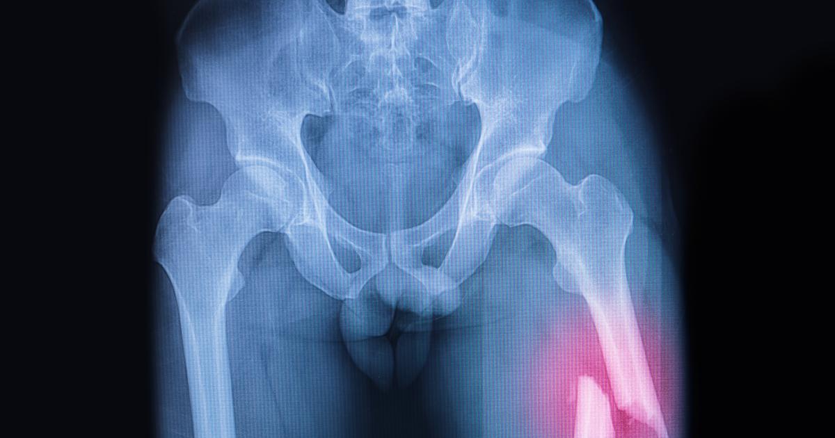 Gebrochener Oberschenkelknochen - Symptome, Ursachen, Behandlungen - Dr.med.Julia.com