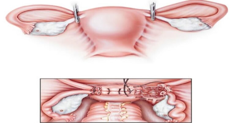 Hysterektomie | Gebärmutterentfernung | Was ist eine Hysterektomie? - Dr.med.Julia.com