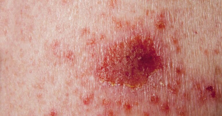 Skorbut - Symptome, Ursachen, Behandlungen - Dr.med.Julia.com